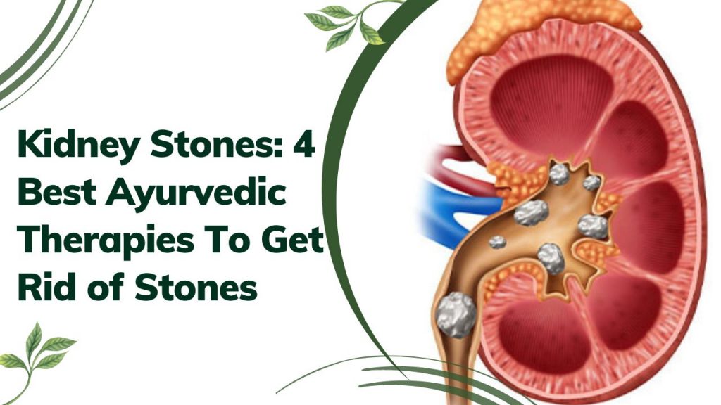 Kidney Stones: 4 Best Ayurvedic Therapies To Get Rid of Stones